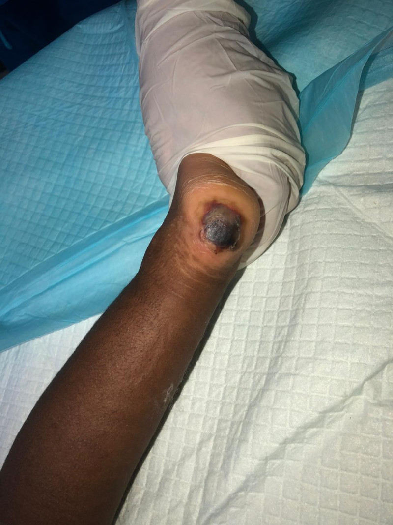 Madre lanza recaudación de fondos para su bebé con celulitis y absceso ...