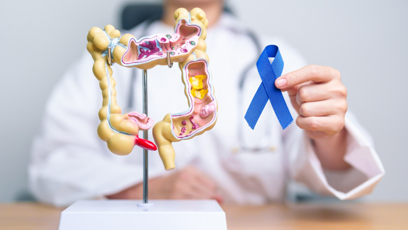 Factores del cáncer colorrectal de aparición temprana podrían ...
