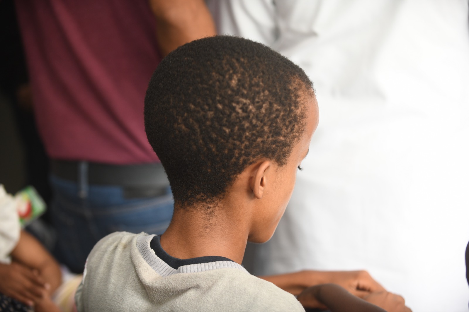 ¿Qué es la hidrocefalia y cuáles son sus causas?