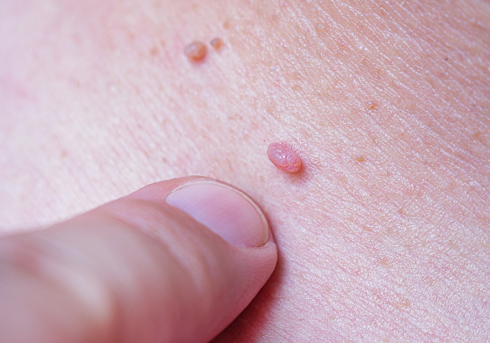 La protección de una sola dosis de vacuna tetravalente contra VPH es ...